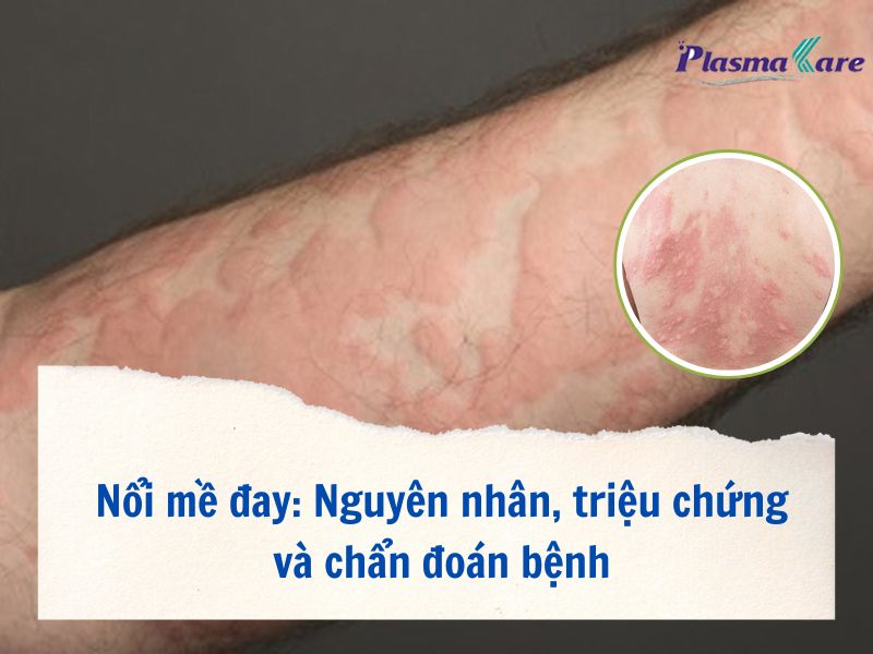 Nổi mề đay: Nguyên nhân, triệu chứng và chẩn đoán bệnh